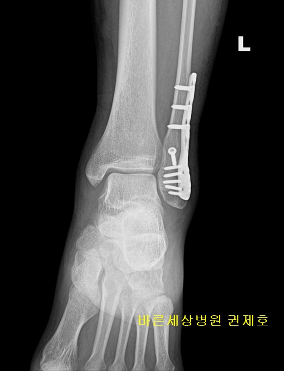 발목 골절 개방적 정복술 및 내고정술 달리기 하는 중에 빙판길에 넘어지면서 발목이 꺽인 후 발생한 발목 골절 치료 목동