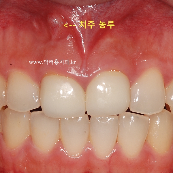앞니 크라운 잇몸 염증 원인과 치료는 네이버 블로그
