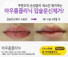 입술색소침착 레이저로 입술색 되돌리기 네이버 블로그
