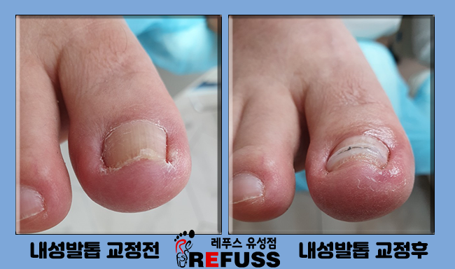 내성발톱 염증 잘못 자른 발톱이 파고들어 생겼어요 네이버 블로그