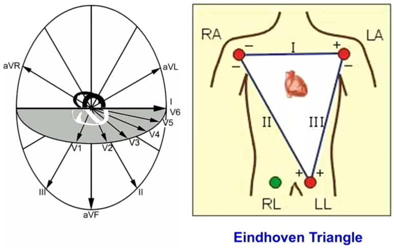 심전도 Case Dextrocardia우심증 왼팔 오른쪽 사지유도 반대 접지 케이스 해석 및 설명 네이버 블로그