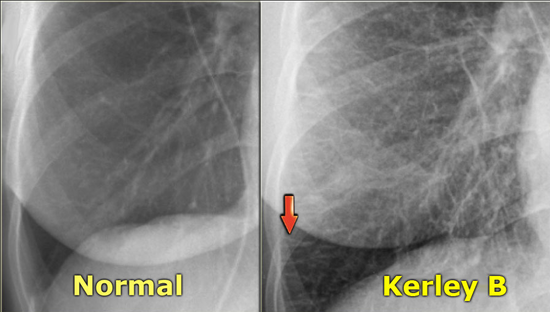X-ray 판독법(consolidation) : 네이버 블로그