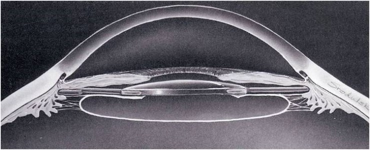 Insertion of Intraocular Lens (IOL) : 네이버 블로그