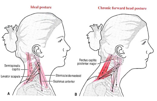 [에이스의 피티존] 거북목 증후군(turtle neck syndrome;forward head posture)에 대한 고찰 ...
