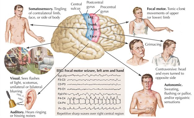 Neurologic Emergency (seizure) : 네이버 블로그